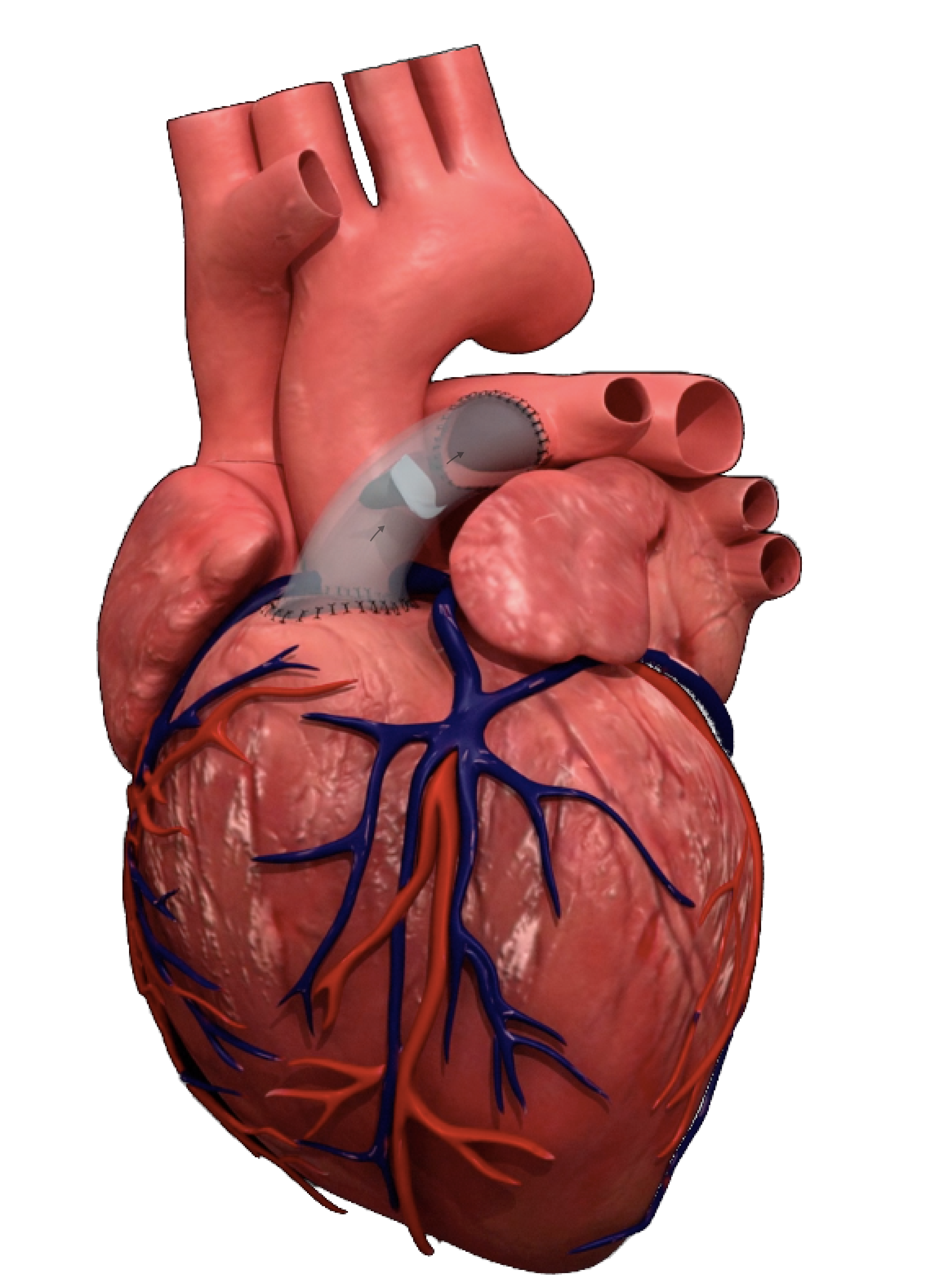 First in-human heart-valve implant that grows with child recipient ...